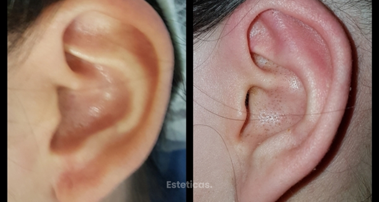 Otoplastia: ¿Qué provoca las orejas en asa o prominentes? - Esteticas ...