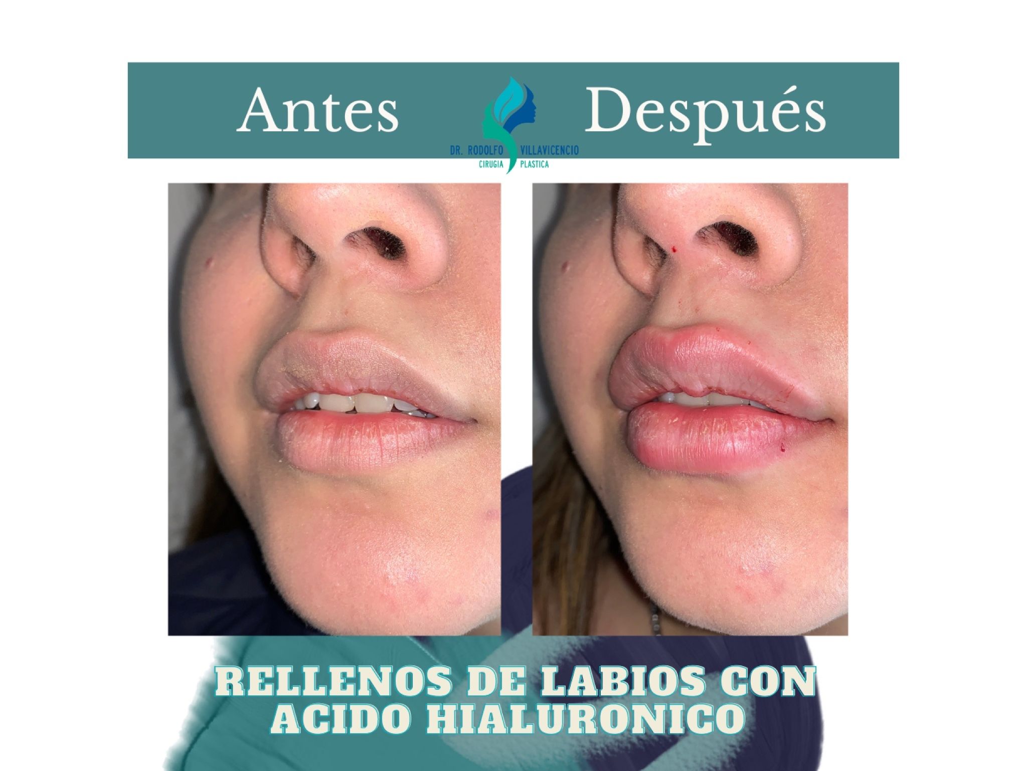 Relleno de labios Antes y después - Esteticas.com.ar - Esteticas.com.ar