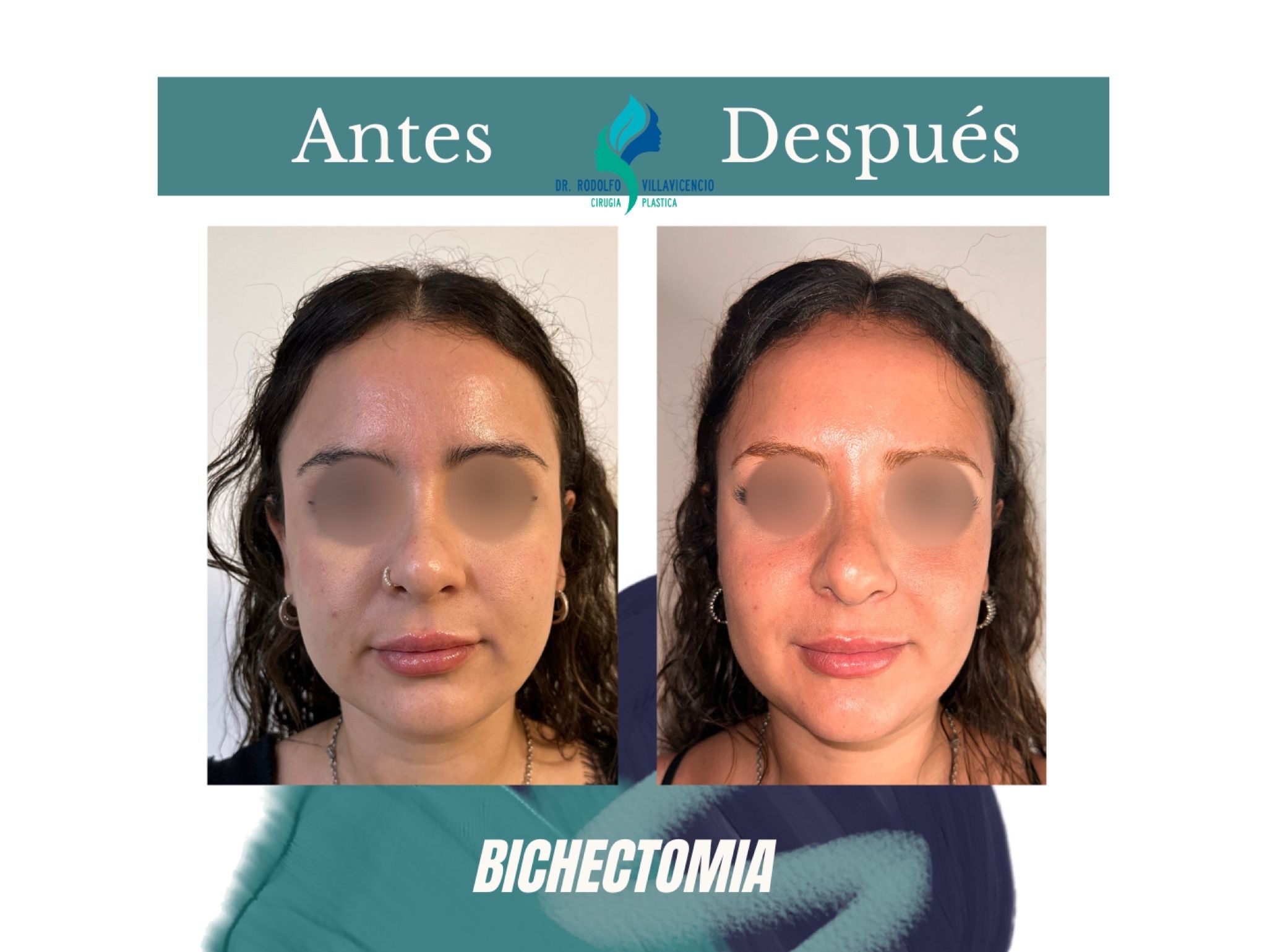 Bichectomia Antes y después - Esteticas.com.ar