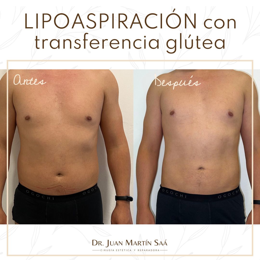 Liposucción Antes y después - Esteticas.com.ar - Esteticas.com.ar