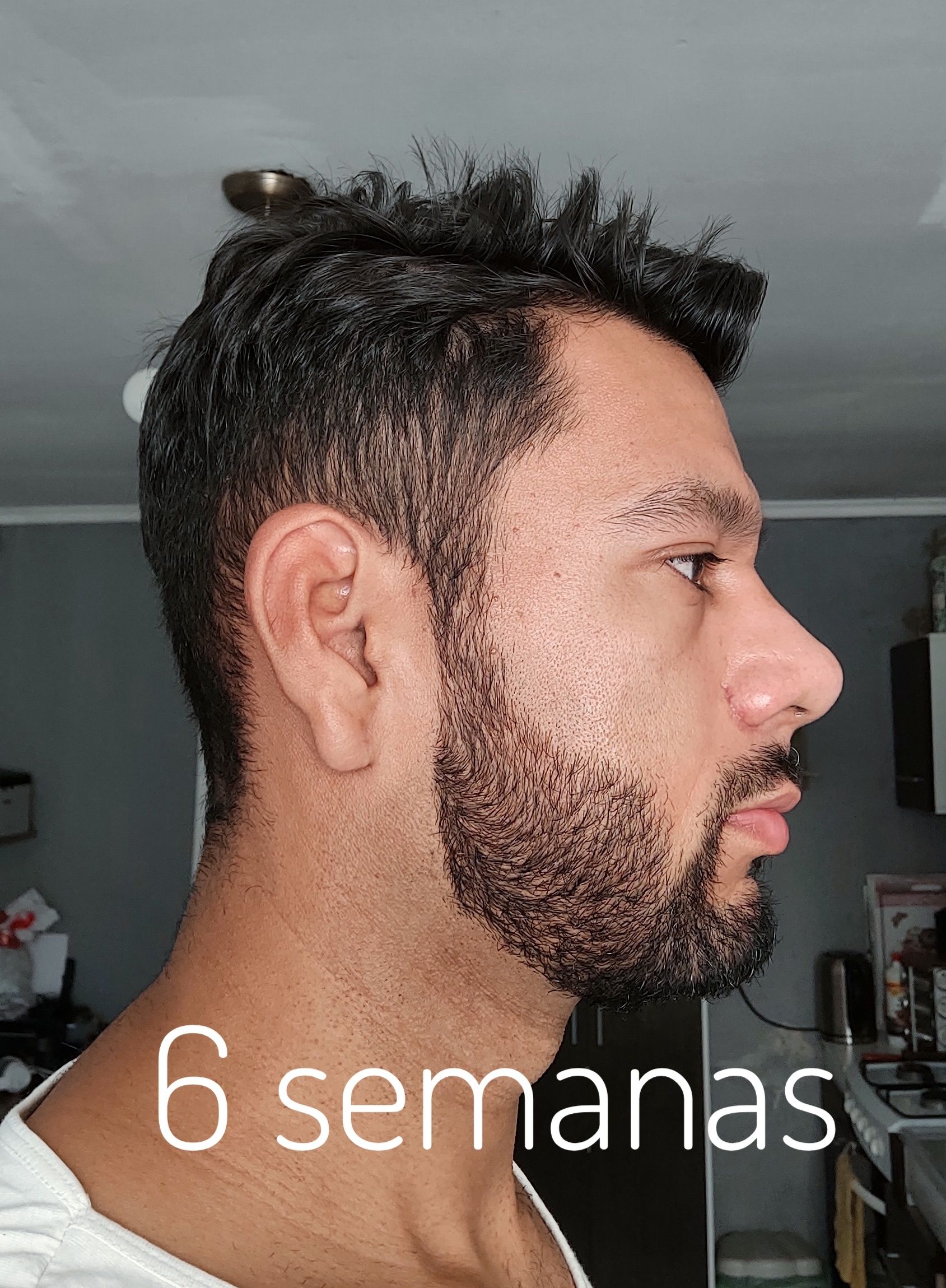 Rinoplastía En Hombre Con Base De Nariz Ancha Y Alargada Rinoplastia