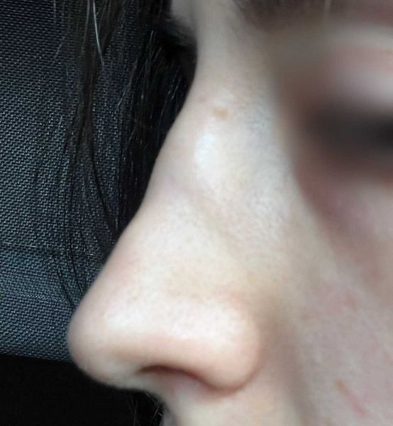 Rinoplastia fibrosis, LunaCattiva, jul 2024