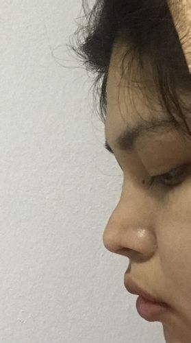 Fibrosis o callo tras segunda rinoplastia - Esteticas.com.ar