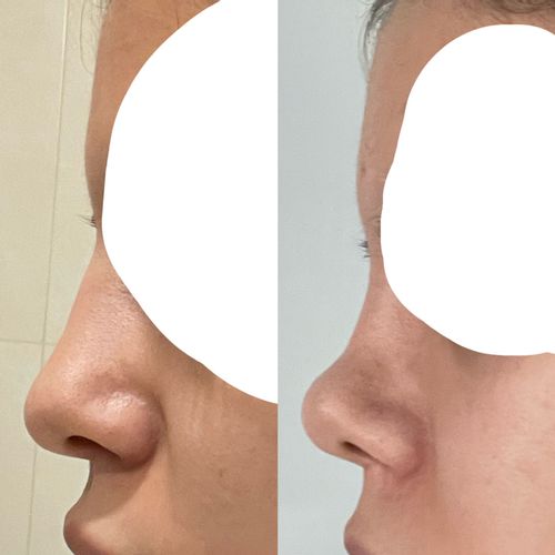 Fibrosis y nariz levantada post rinoplastia - Esteticas.com.ar