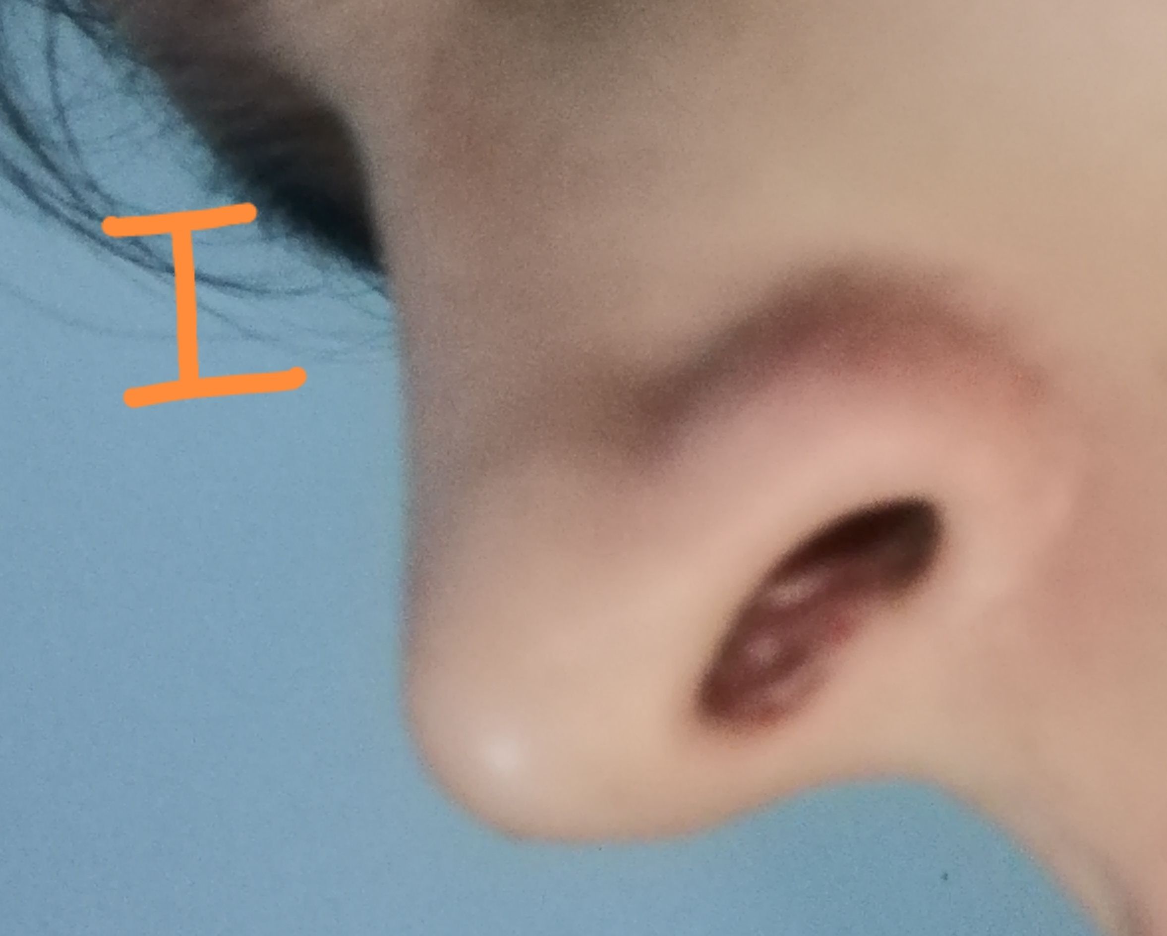 Bulto por inflamación o fibrosis post 4 meses rinoplastia - Esteticas ...