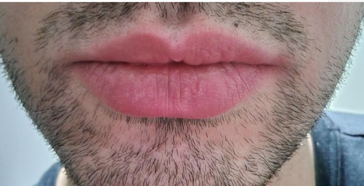 Cicatriz en el labio que borro la comisura - Esteticas.com.ar